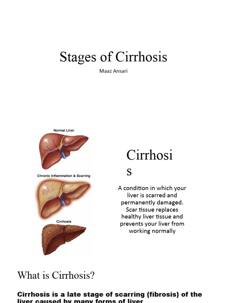Stages of Cirrhosis: Maaz Ansari | PDF | Wellness | Science & Mathematics