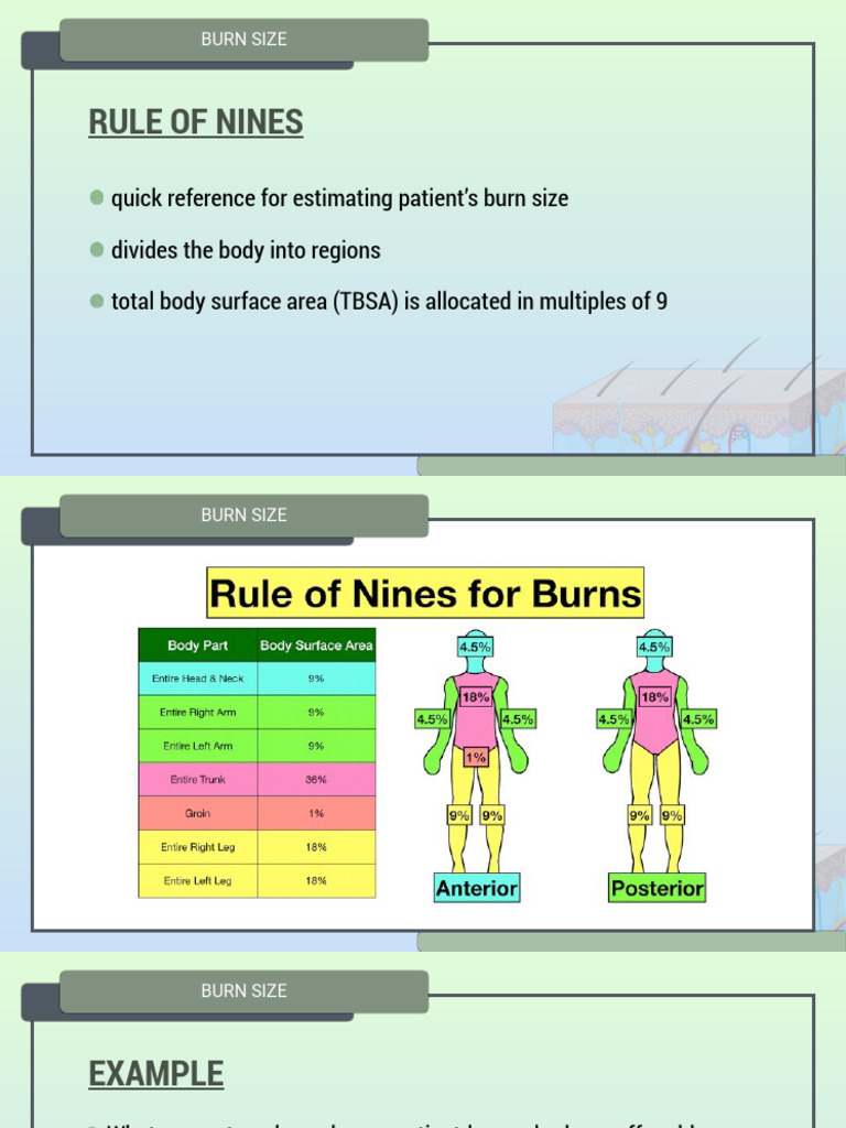 Special Topic Rule of Nines | PDF