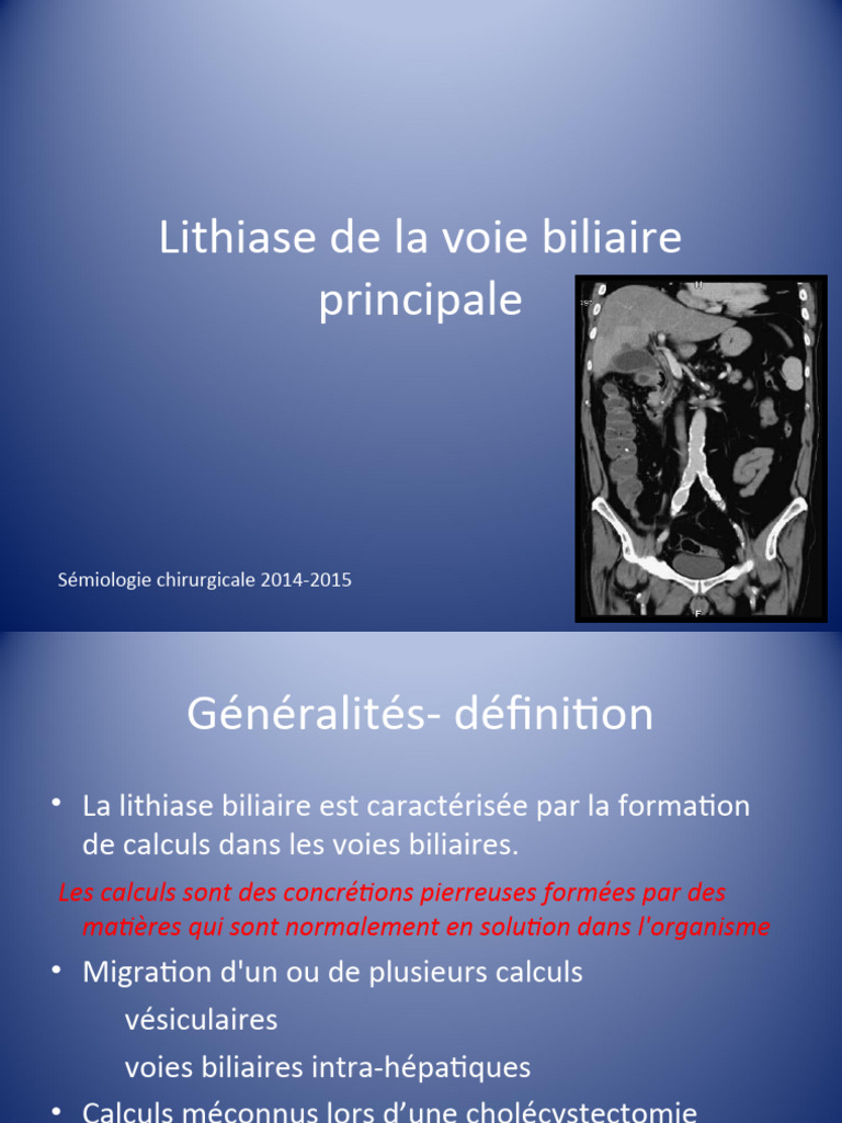 Lithiase Voie Principale | PDF