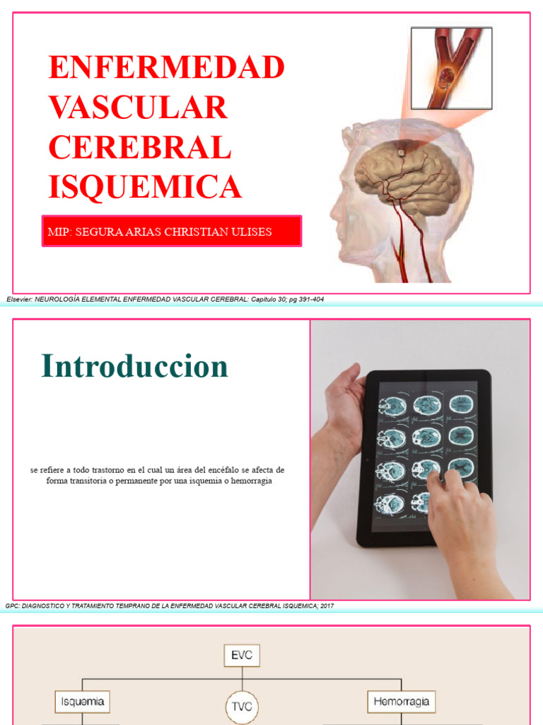 Enfermedad Vascular Cerebral Isquemica | Descargar gratis PDF | Isquemia | Carrera