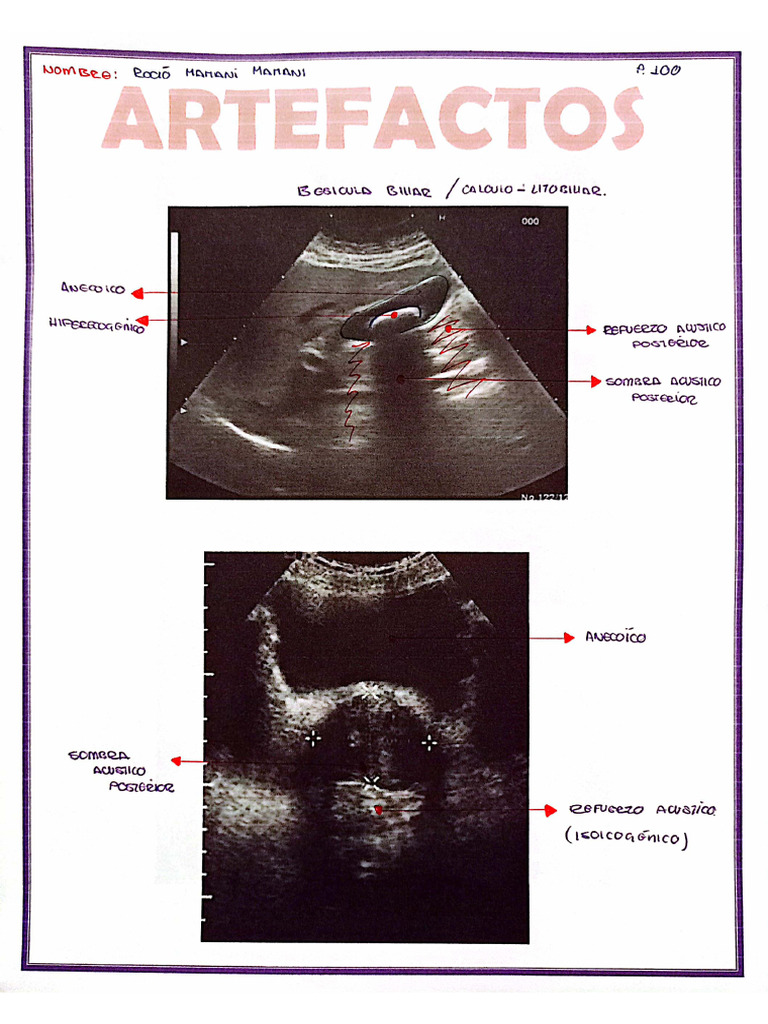 ARTEFACTOS EN ECOGRAFIA | PDF