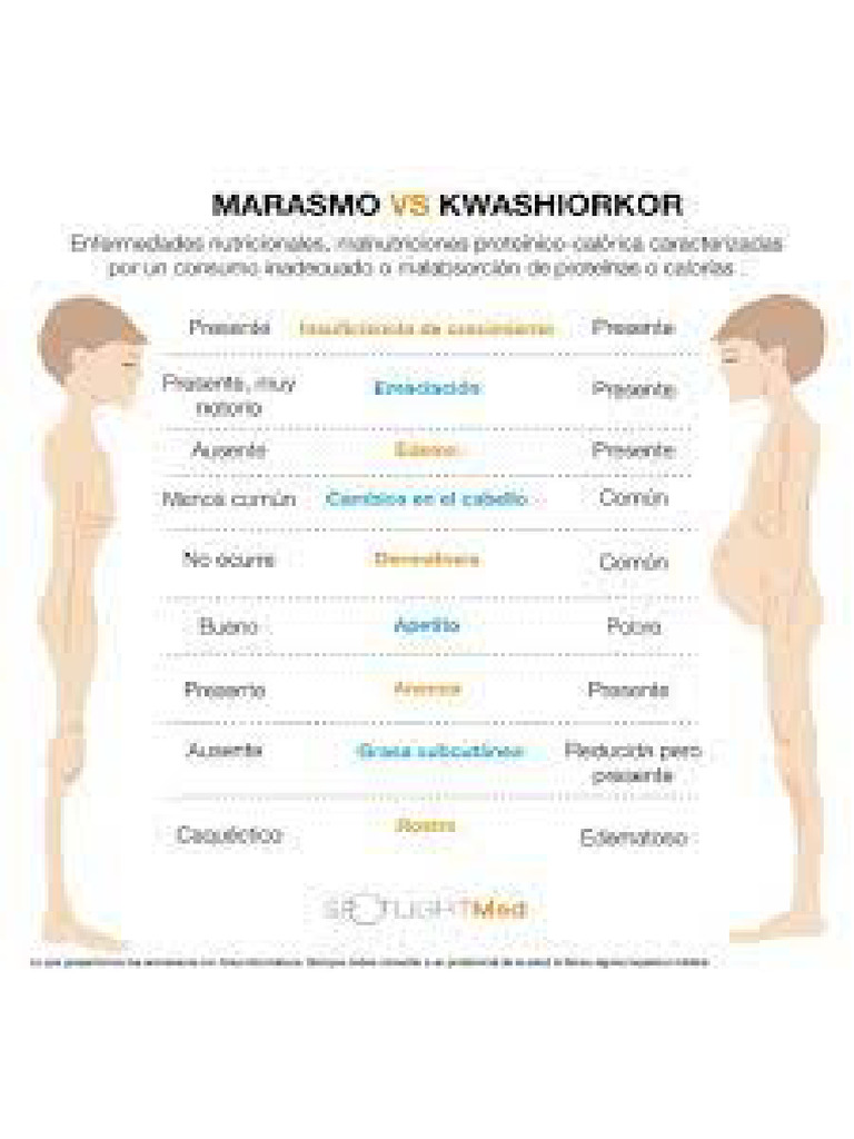 Marasmo VS Kwashiorkor | PDF