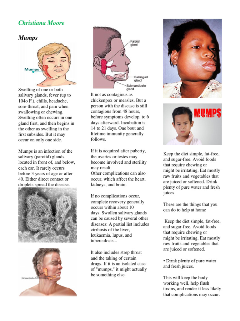 Mumps | PDF