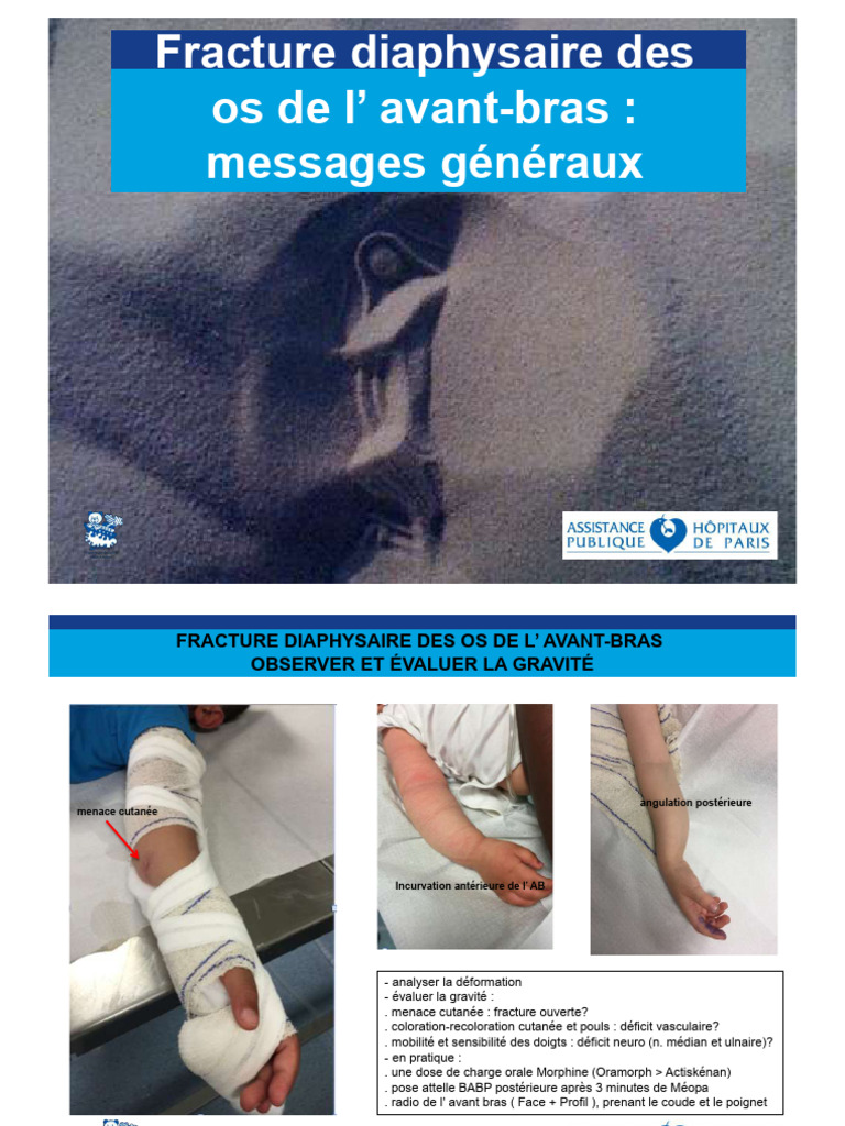 Fracture diaphysaire avant-bras : évaluation et traitement | PDF ...