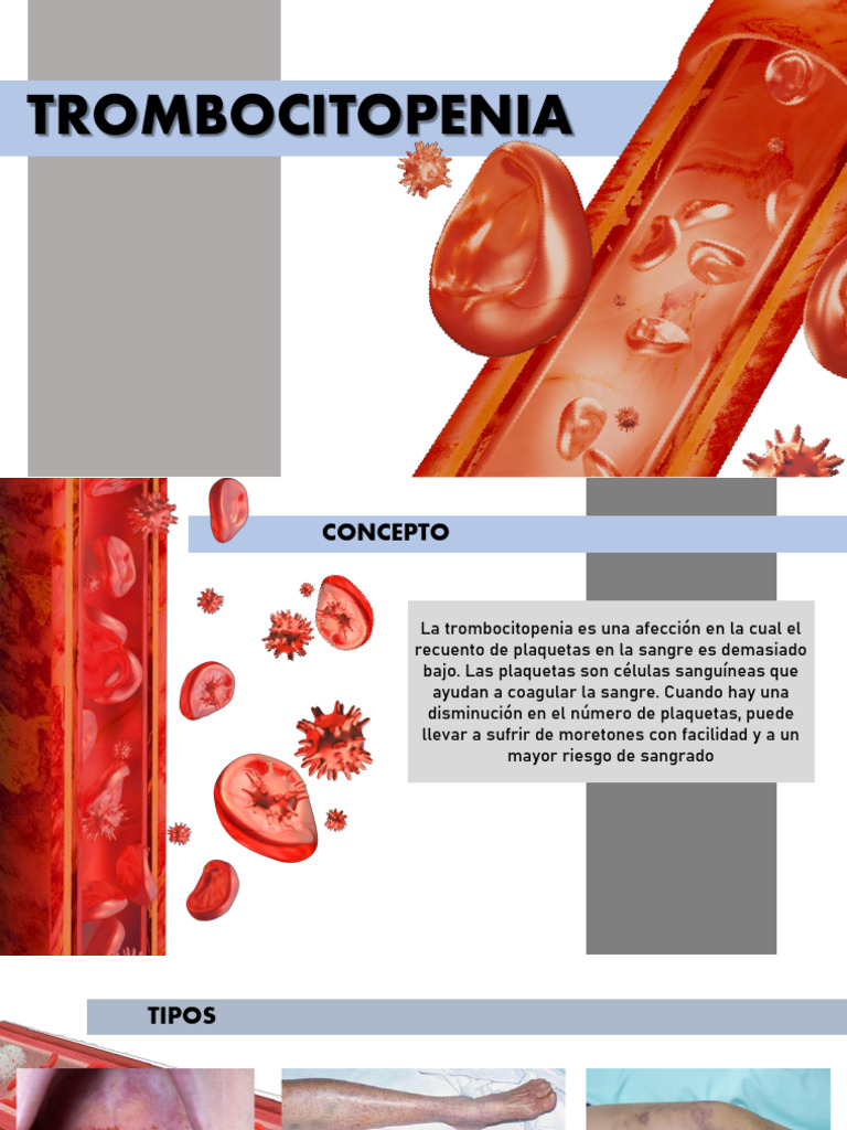 TROMBOCITOPENIA - Planes de Cuidados de Enfermeria | PDF | Plaqueta ...