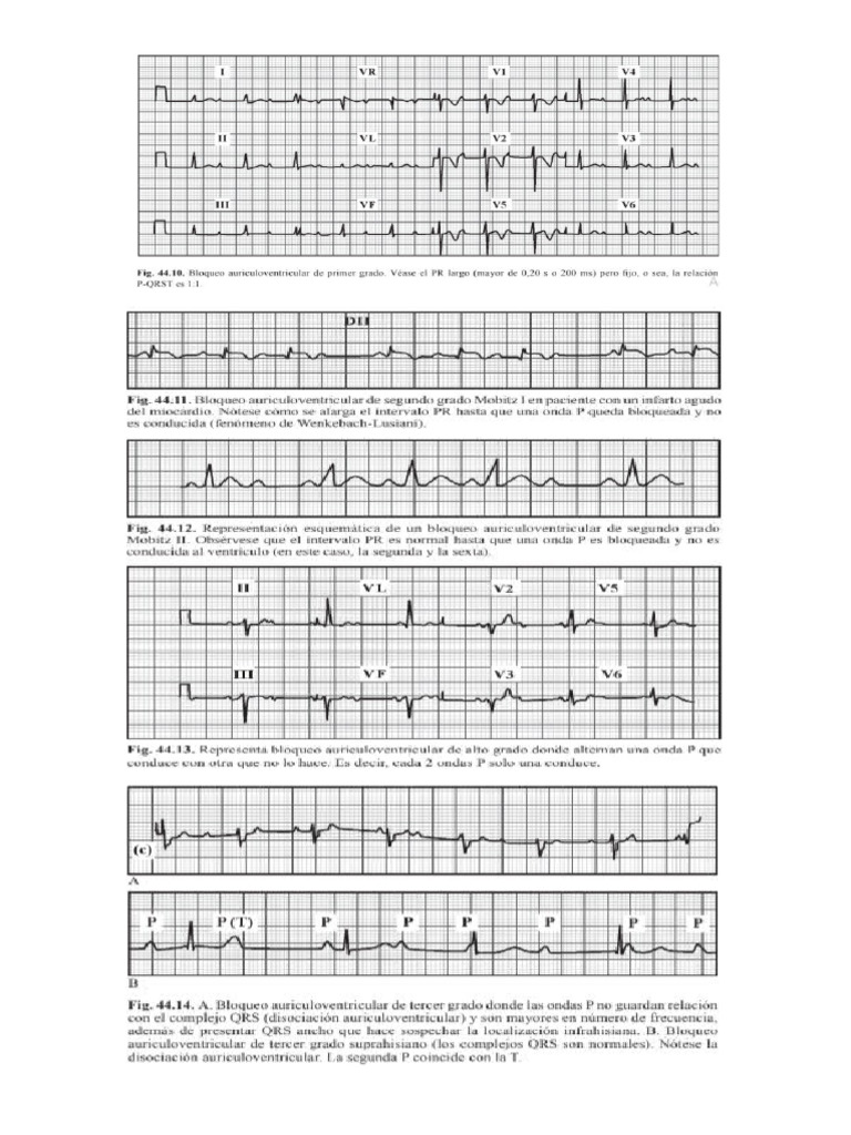 Ecg Bloqueos Auriculoventricular | PDF