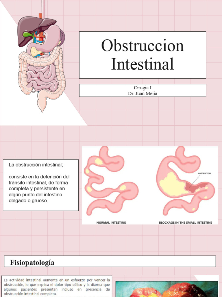 Obstruccion Intestinal | PDF