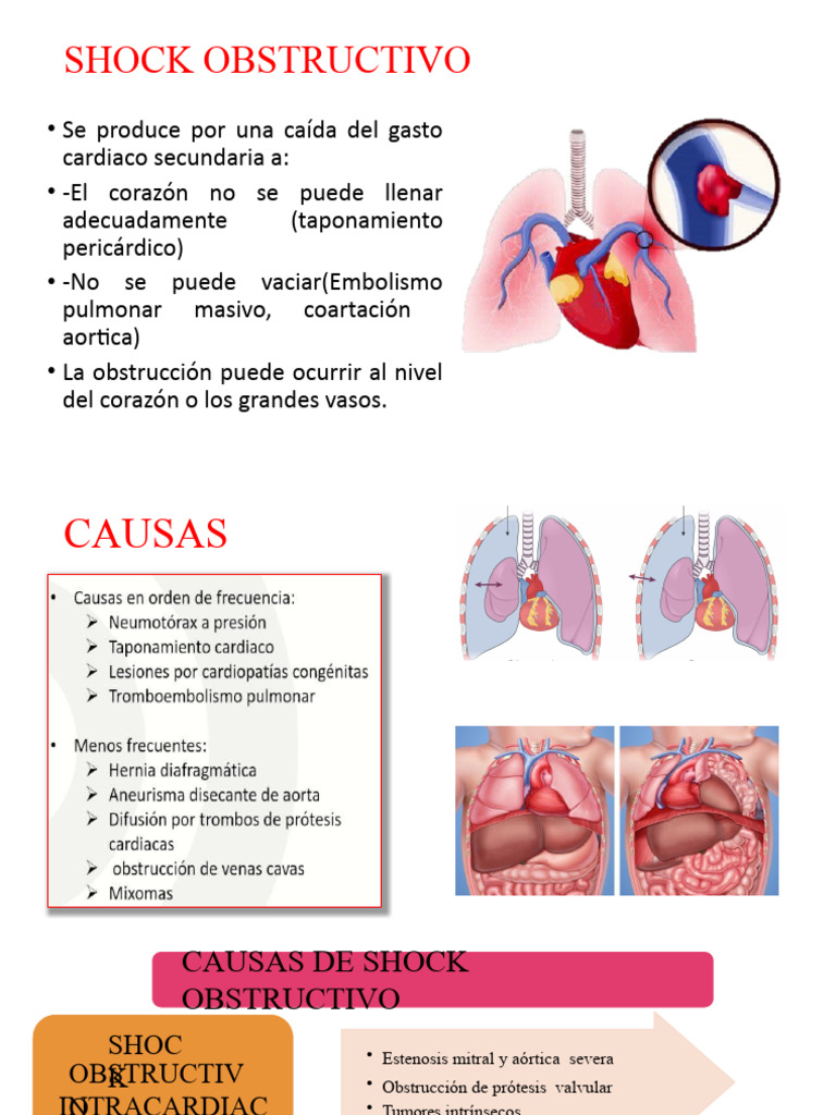 Shock Obstructivo | PDF