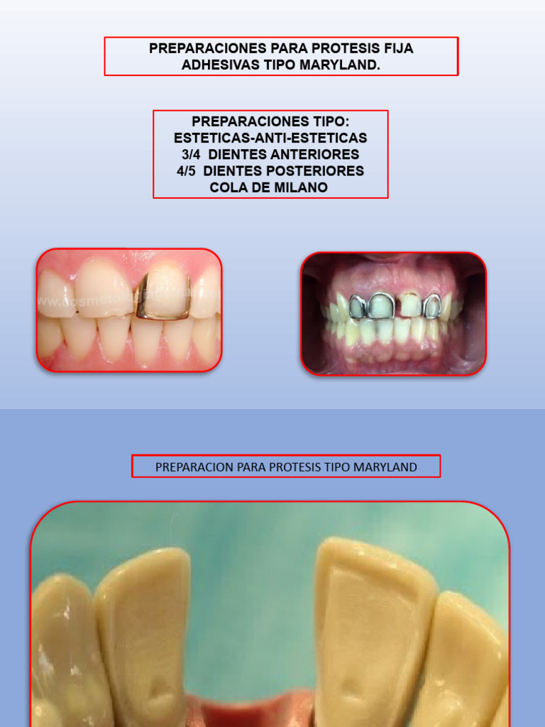 Teoria - Preparacion Adhesivas Maryland | PDF