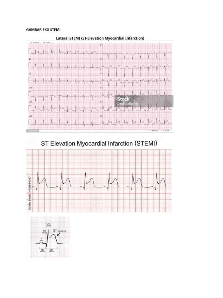 GAMBAR EKG STEMI | PDF