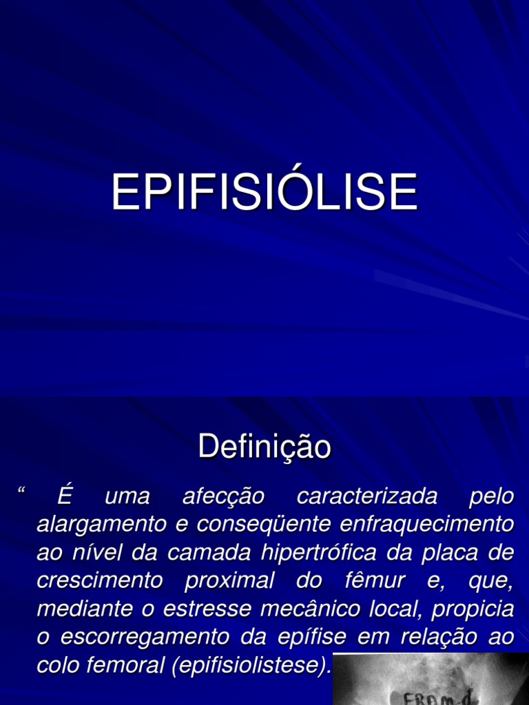 Epifisiólise: Causas, Sintomas e Diagnóstico | PDF | Sistema Locomotor ...
