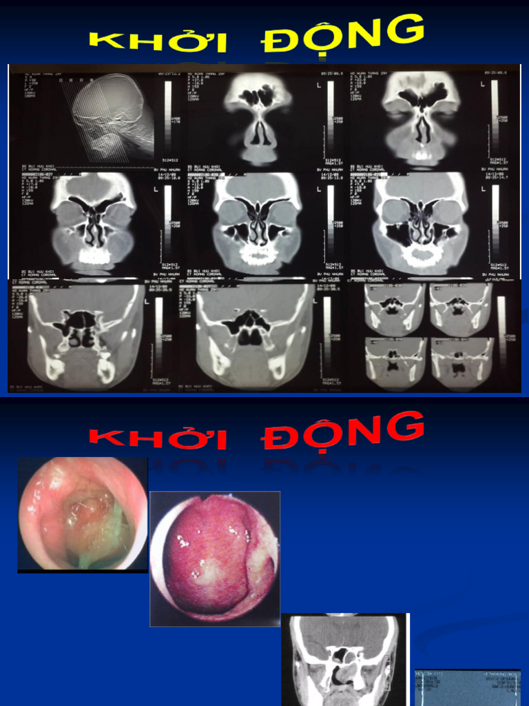 Ung Thu Vom Hong | PDF