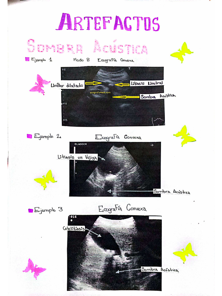 Artefactos de La Ecografía | PDF