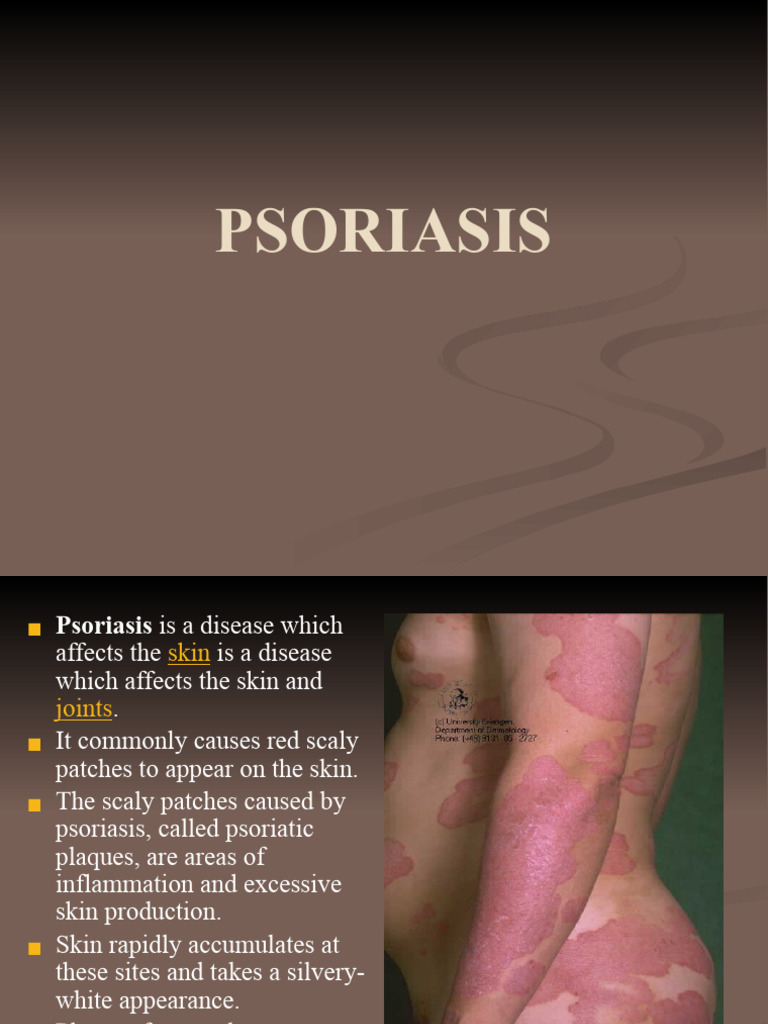 Psoriasis | PDF | Psoriasis | Skin