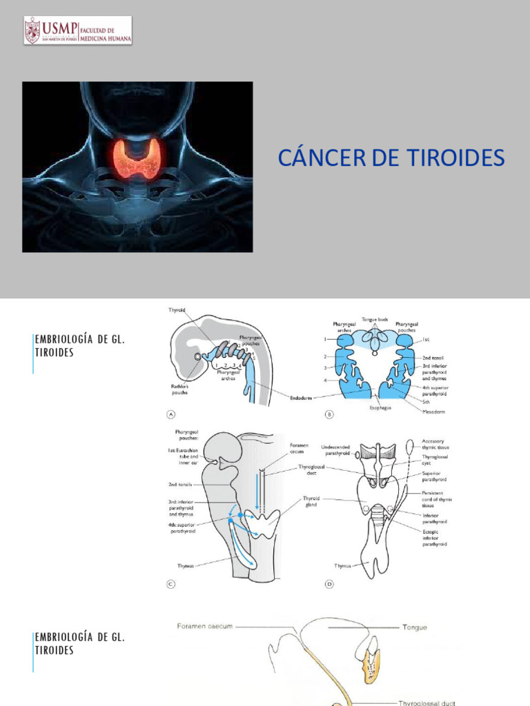 Clase 01 Cáncer de Tiroides | PDF | Endocrino | Endocrinología