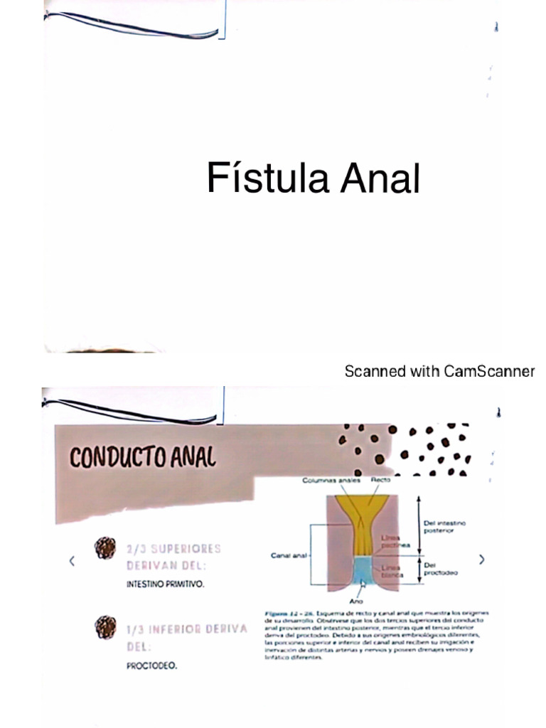 Fístula Anal | PDF