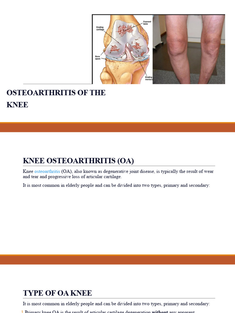 Oa Knee | PDF | Knee | Osteoarthritis