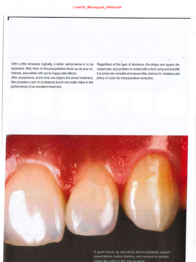 Layers 2 Direct Composites 12 Pdf Orthodontics Mouth
