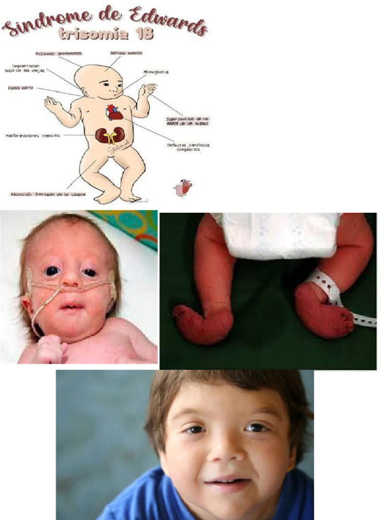 Sindrome de Edward | PDF
