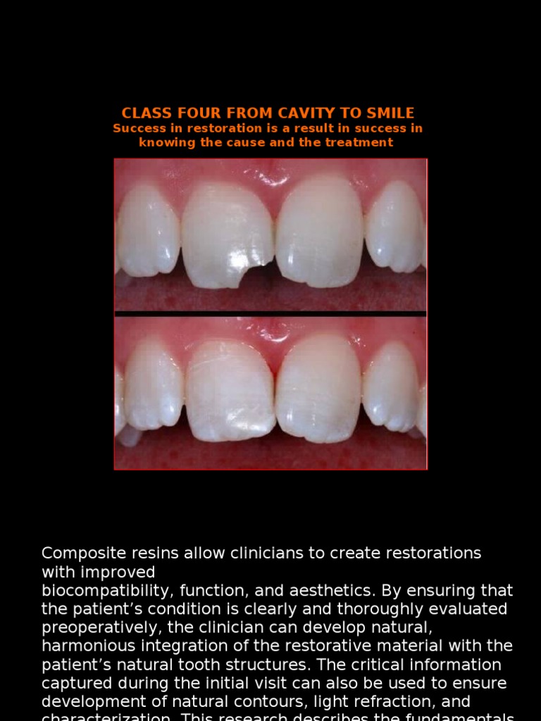 Restoring Harmony: A Guide to Successful Class IV Composite ...