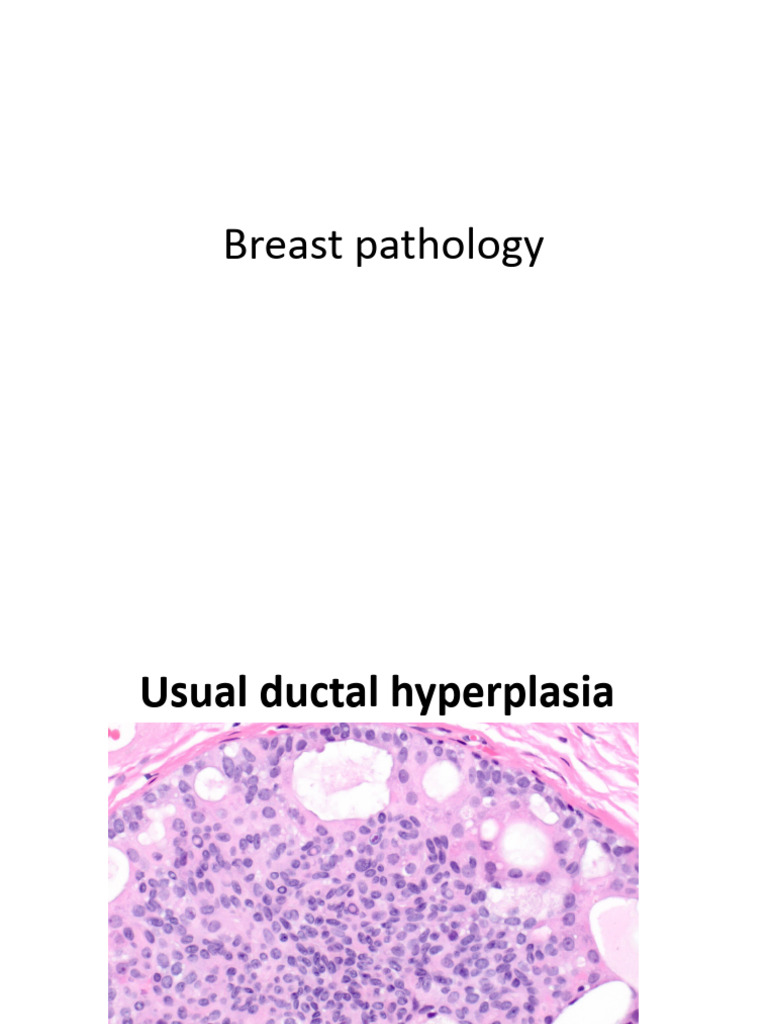 Breast Lesions Pic For Board | PDF | Carcinoma | Epithelium