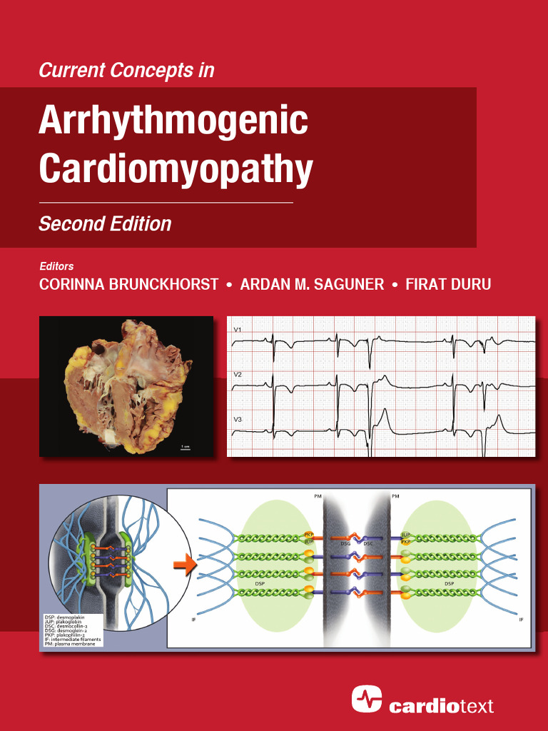 Arrhythmogenic Cardiomyopathy | PDF | Cardiology | Electrocardiography