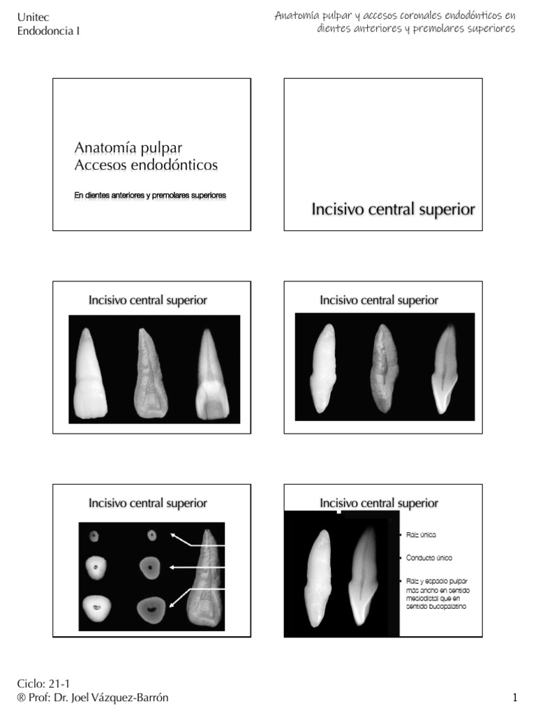 Anatomía pulpar y accesos endodónticos en dientes anteriores y ...