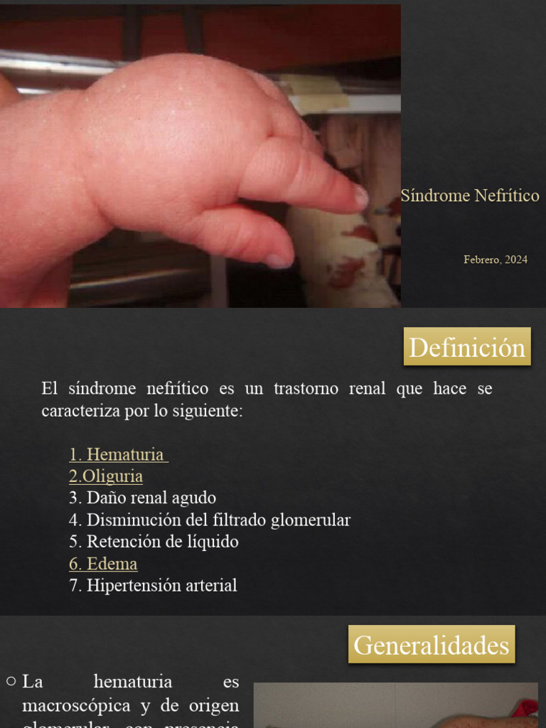 Síndrome Nefrítico: Causas y Tratamiento | PDF | Riñón | Especialidades ...