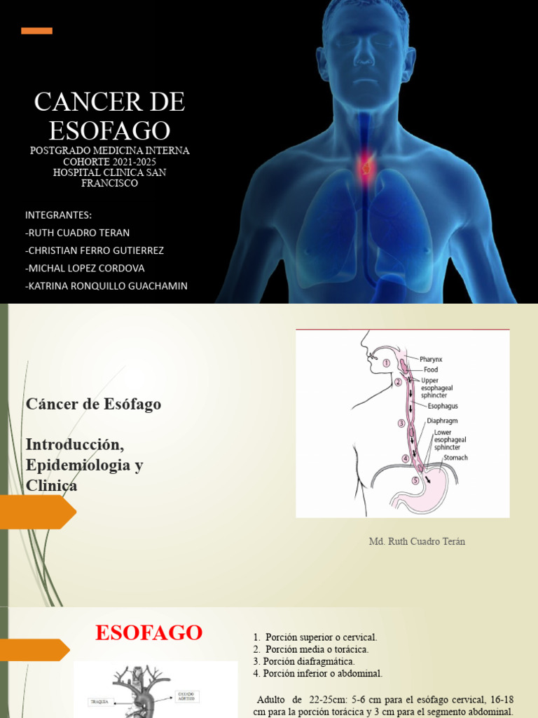 Cáncer Esofágico | PDF | Cáncer | Terapia