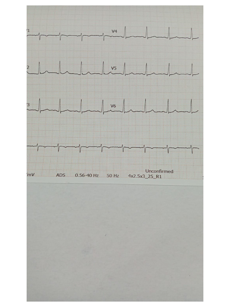 Ecg pdf | PDF