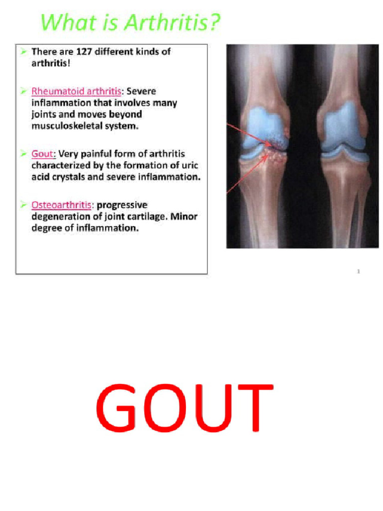 Pathophysiology of Gout | PDF