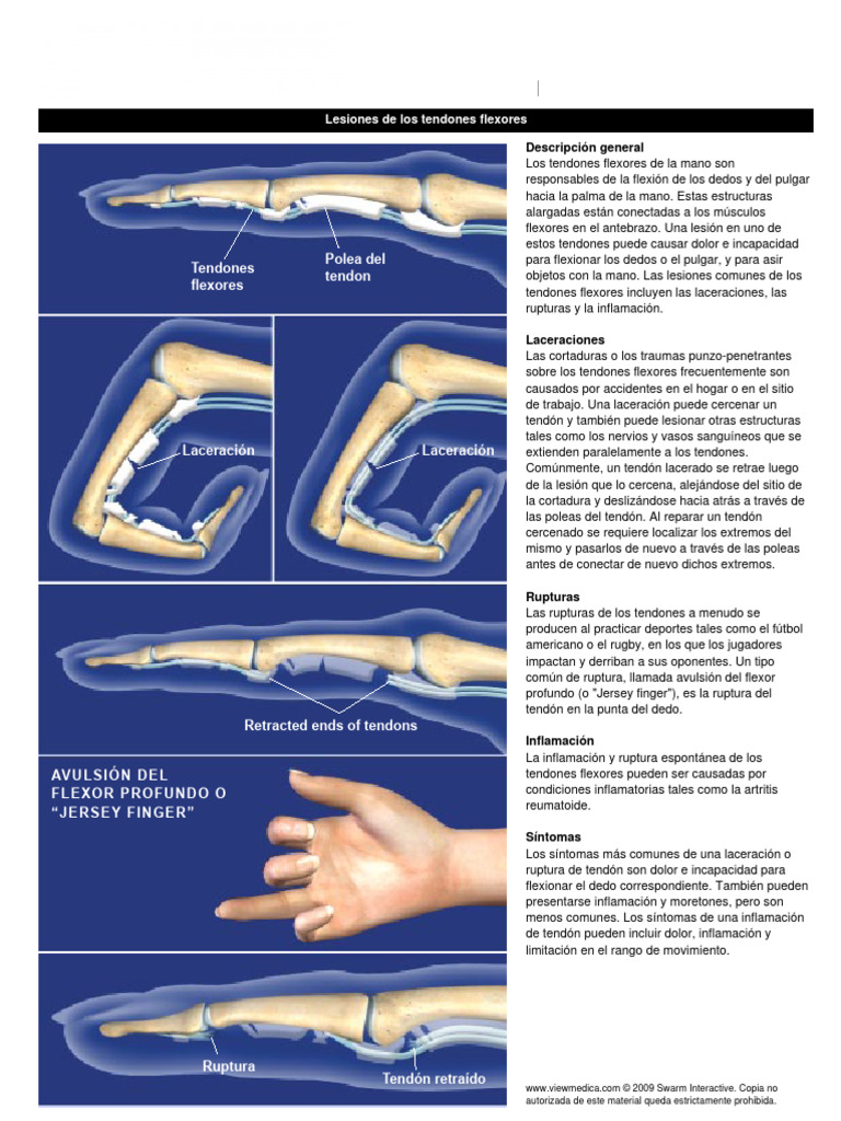 FlexorTendonInjuries SPANISH 07apr14 | PDF | Tendón | Mano