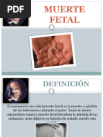 Distocia Funicular: Definición y Evaluación | PDF | Parto | Feto