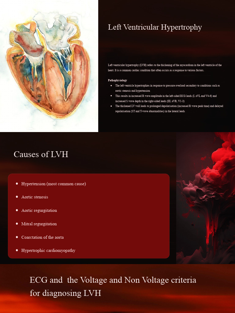 ECG Signs of Left Ventricular Hypertrophy | PDF | Electrocardiography ...