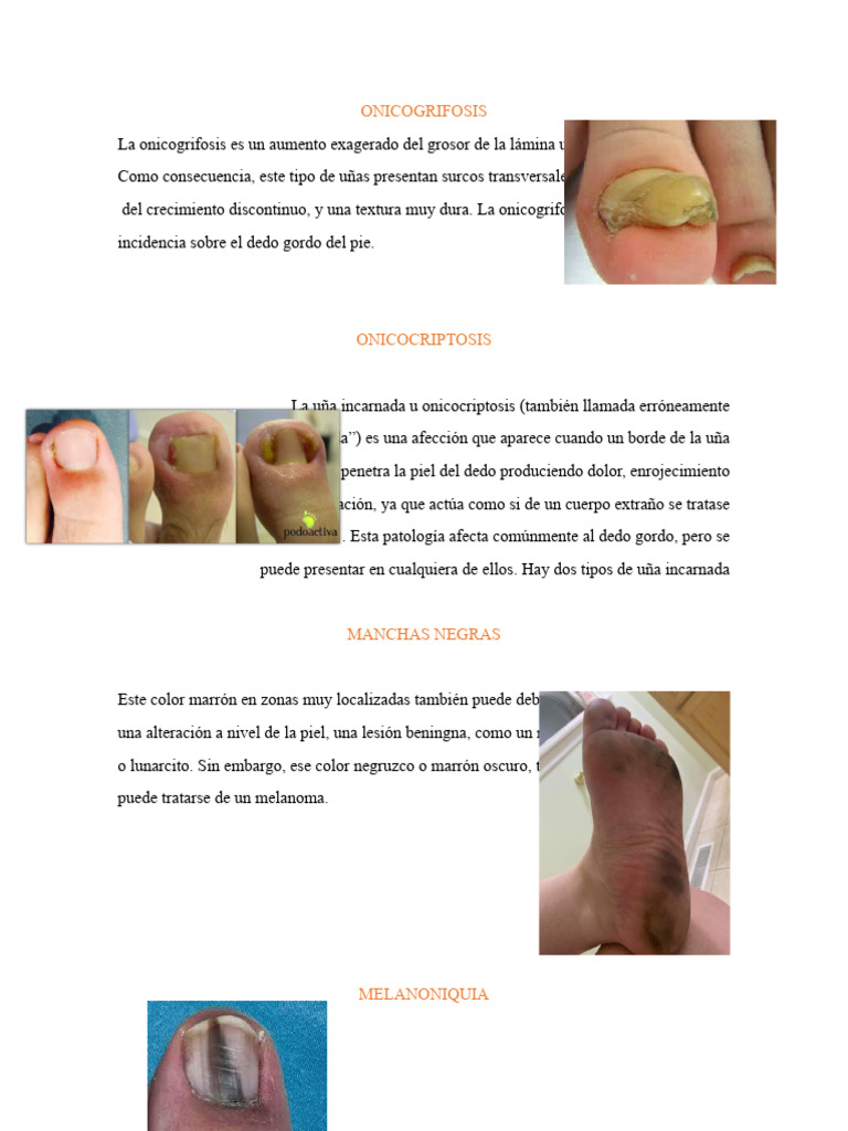 Causas y características de onicogrifosis | PDF | Clavo (anatomía) | Piel