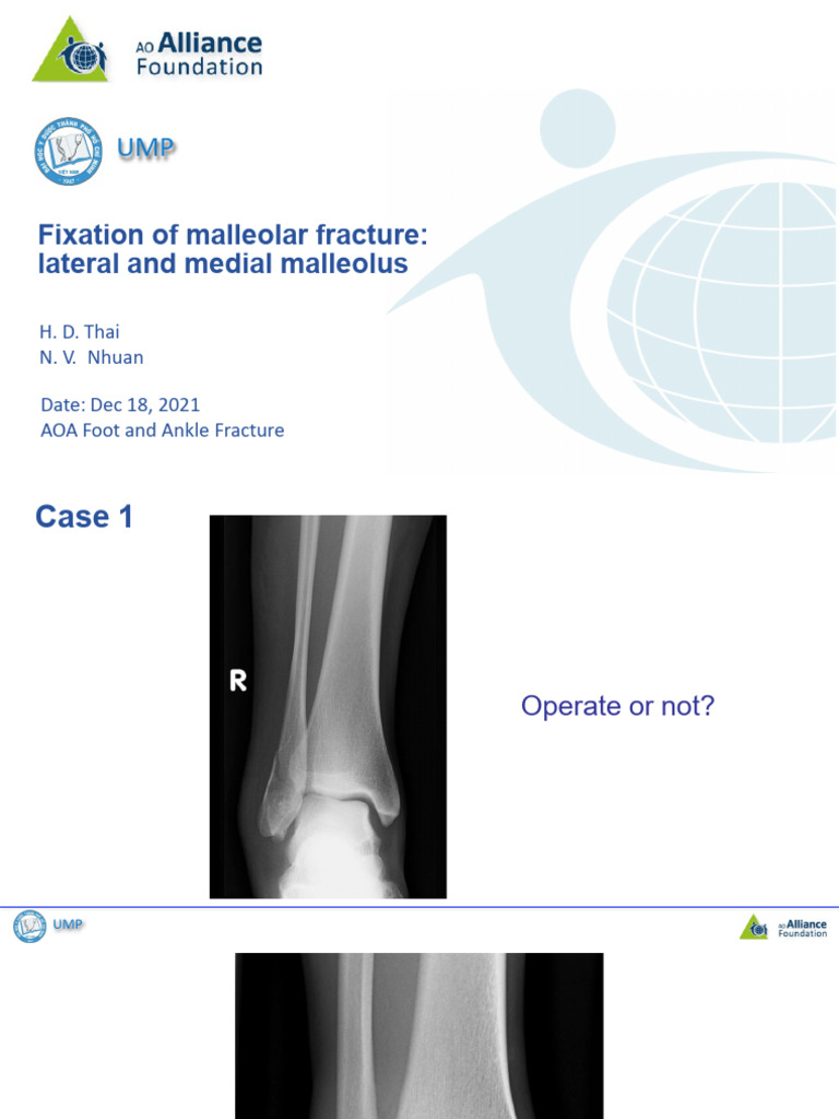 Malleolar Fracture Treatment Insights | PDF | Ankle | Skeletal System