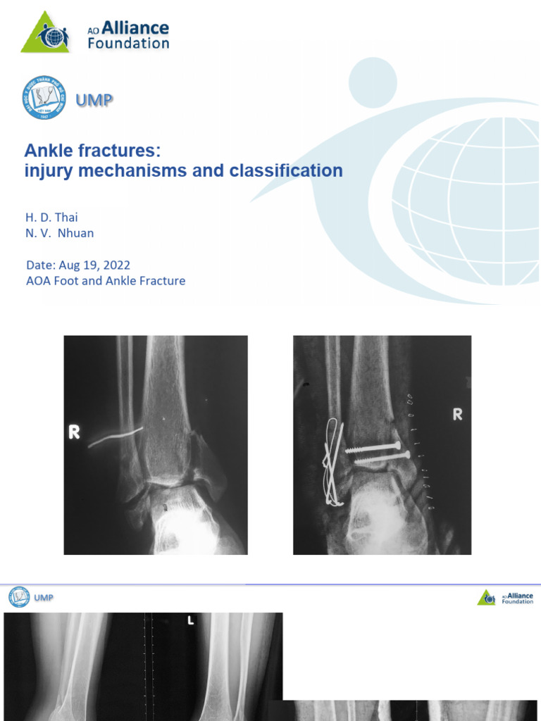 1.2 Ankle Fracture Classification | PDF | Ankle | Lower Limb Anatomy