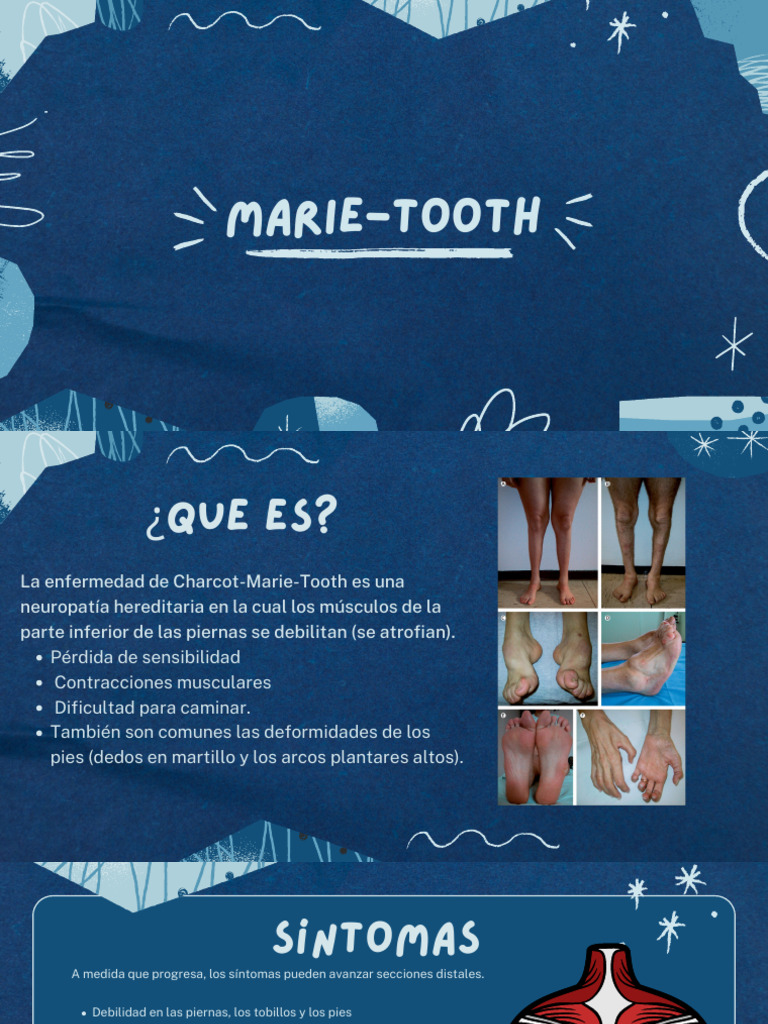 Marie Tooth | PDF | Mielina | Sistema nervioso