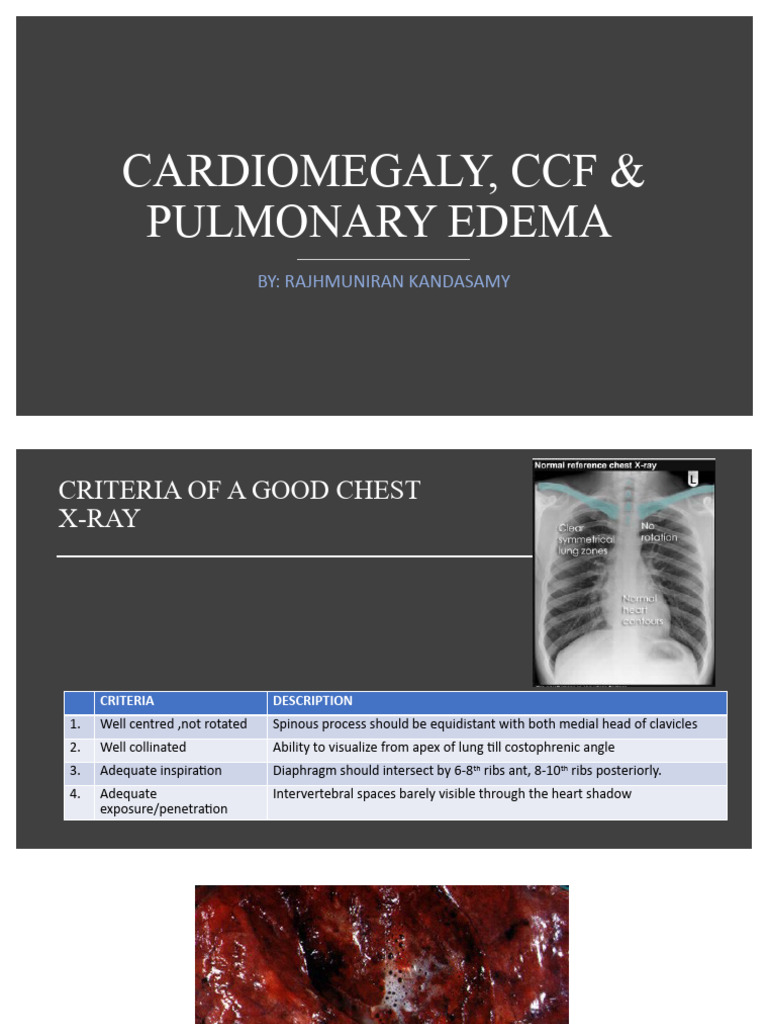 Cardiomegaly, CCF, Pulmonary Edema | PDF | Lung | Heart