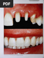 G.V. Blacks Classification of Caries | PDF | Animal Anatomy | Health ...