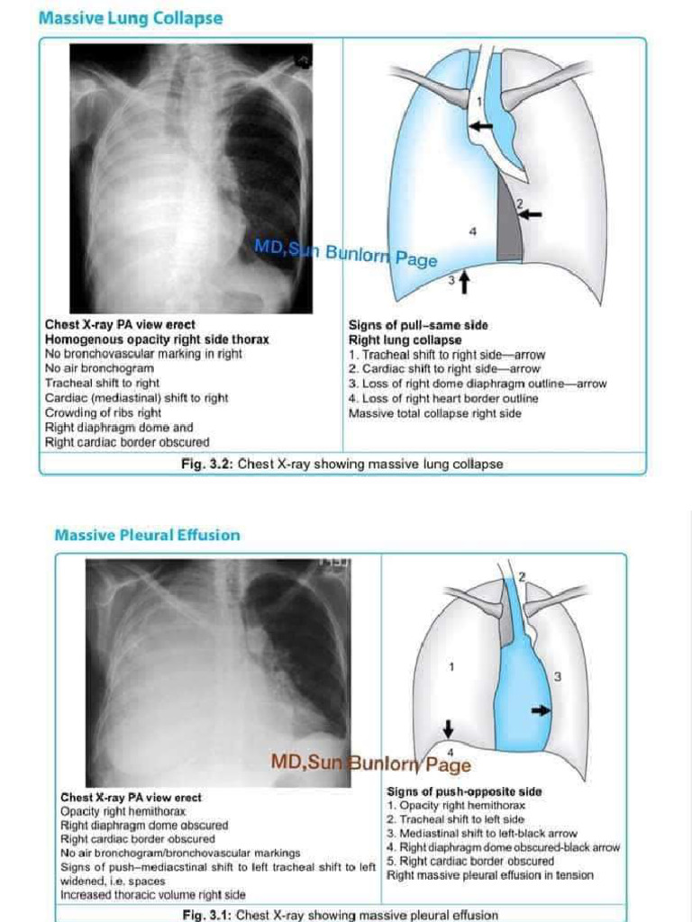 chest x ray | PDF