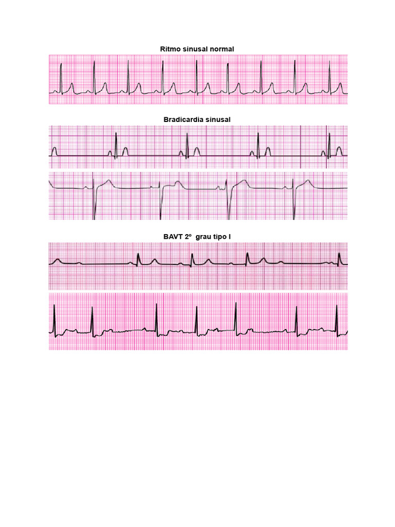 Ritmos Cardíacos ACLS | PDF