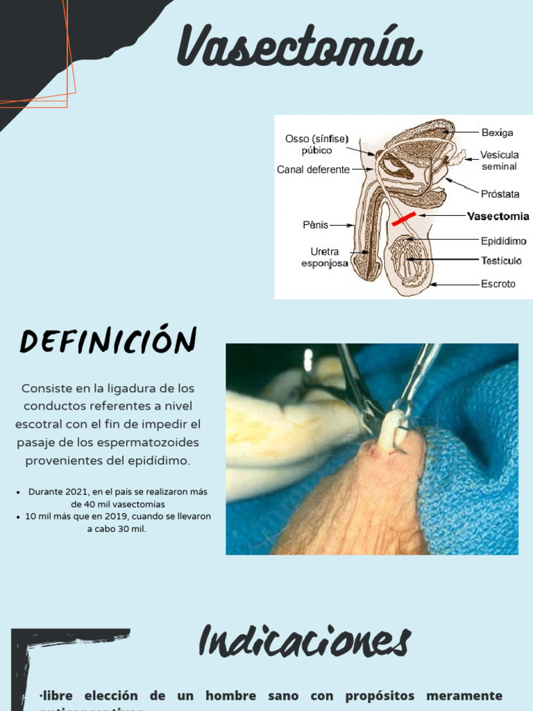 Vasectomía | PDF | Especialidades Medicas | Reproducción humana
