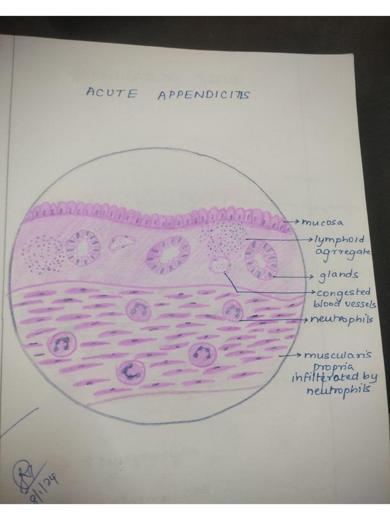 Acute Appendicitis Pdf