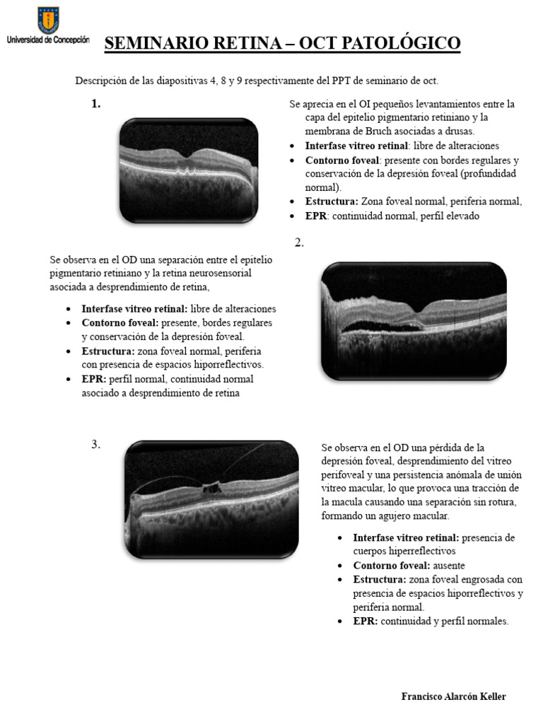 OCT Patológico Retinaa | PDF | Rasgos faciales | Sentidos