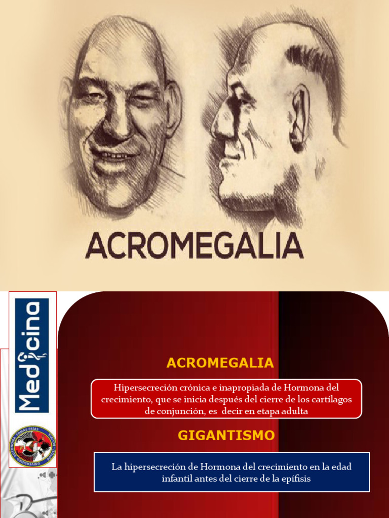 Acromegalia | PDF
