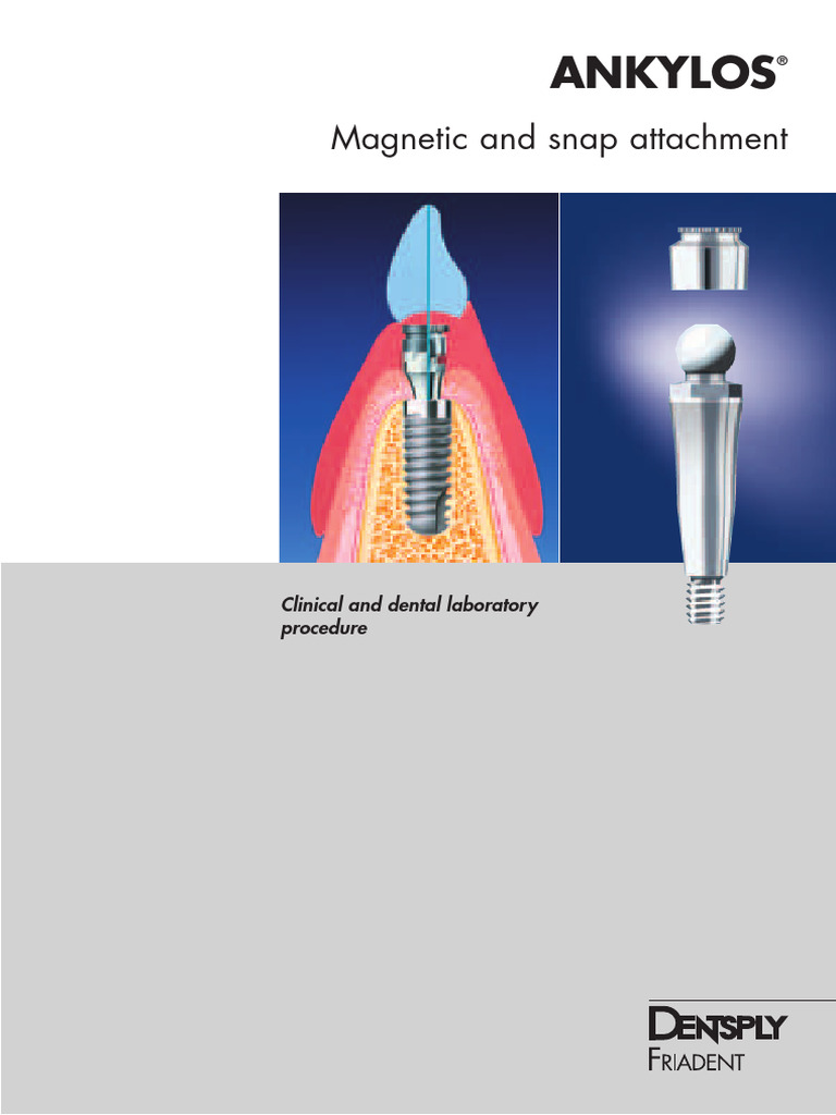 Magnetic and Snap Attachment | PDF | Dental Implant | Dentures