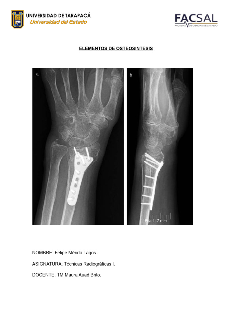Elementos de Osteosíntesis en Fracturas | PDF | Hueso | Tornillo