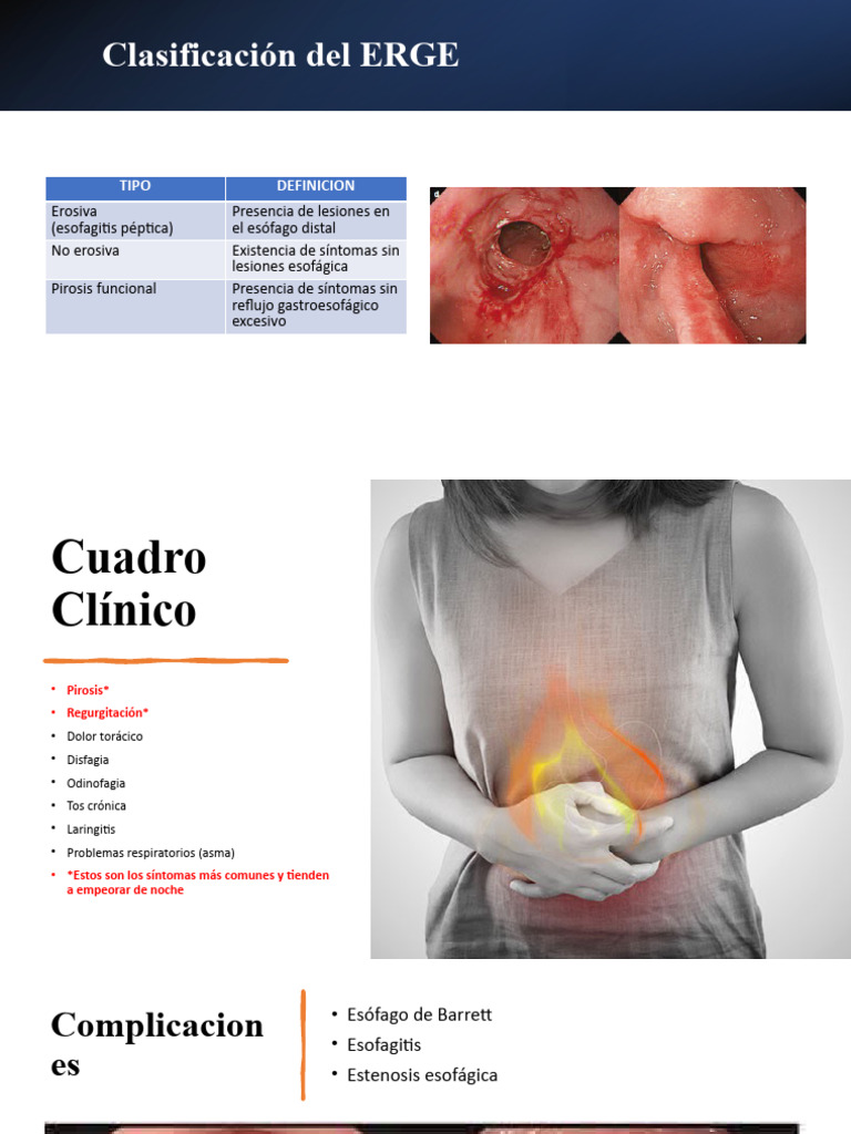 ERGE Expo | PDF | La enfermedad por reflujo gastroesofágico | Enfermedades y trastornos