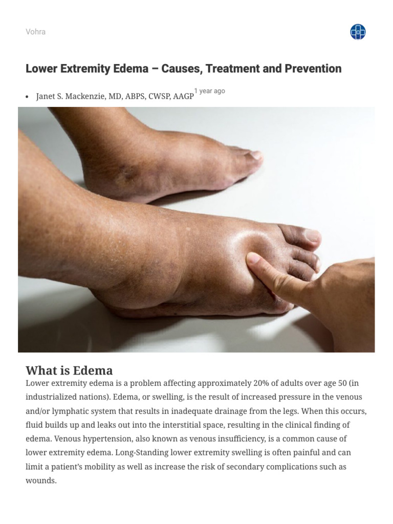 Lower Extremity Edema - Causes, Treatment, and Prevention | PDF | Edema ...